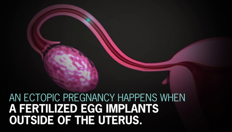 What is Ectopic Pregnancy? | Pregnant Life