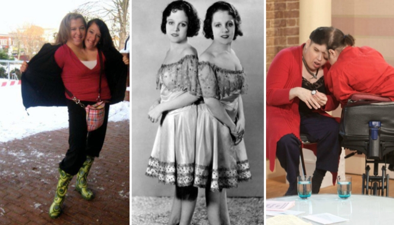 The Most Amazing Conjoined Twins | Pregnant Life